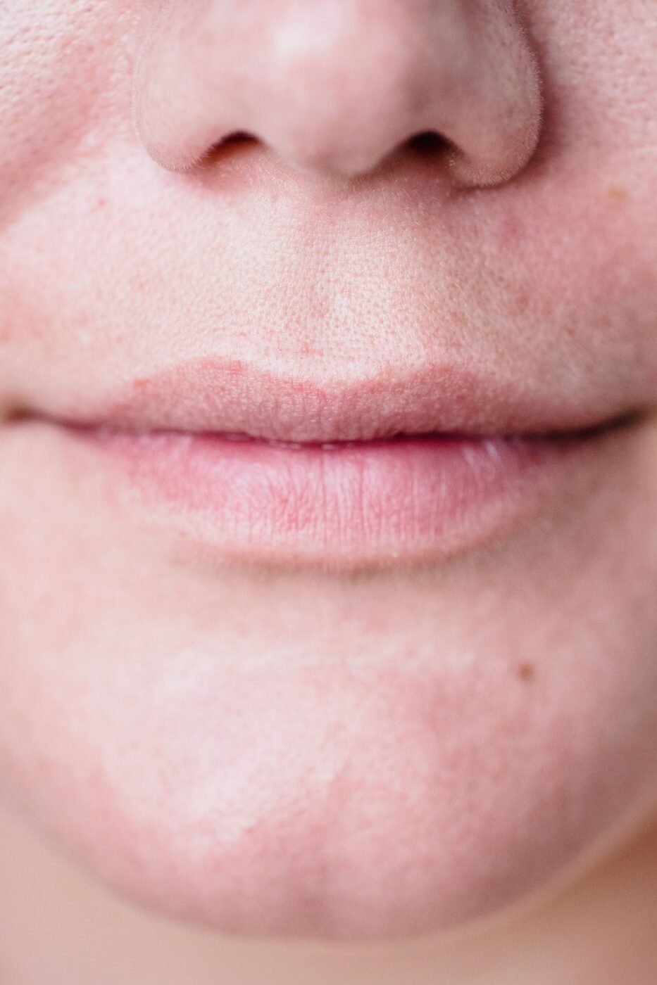 Juvederm OC - OrangeTwist